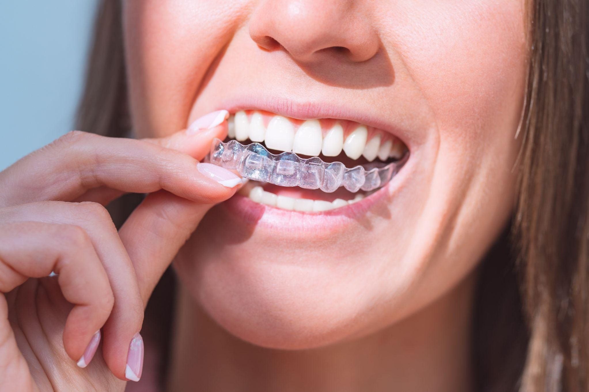 Why Does My Retainer Smell? – Ola Fresh - Professional Strength Dental ...